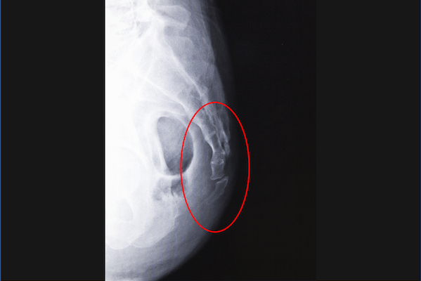 Why Do You Feel Tailbone Pain When Sitting down and Getting up?